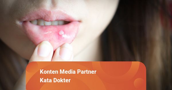 Sariawan di Bibir: Gejala, Penyebab, dan Cara Mengobatinya | kumparan.com